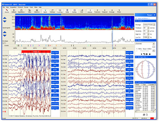 EEG - www.Cephalon.eu